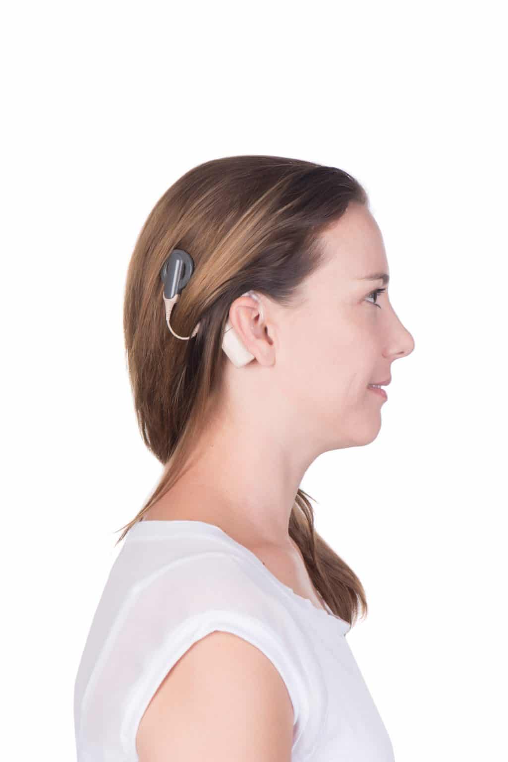 Implantable Hearing Devices | Dubuque ENT
